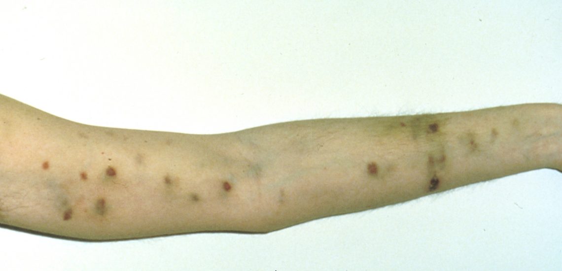 Sarcoma – A Life Threatening Cancer - Hooked On Everything